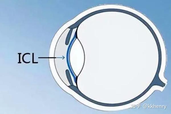 矫正视力黑科技——ICL可植入式Collamer晶体 - 知乎