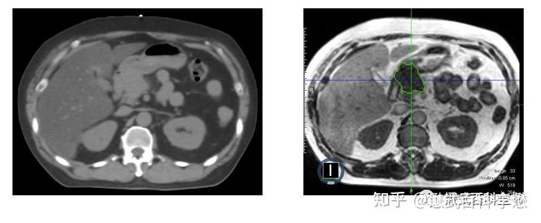 MRIdian Linac 磁共振引导放疗系统介绍 - 知乎