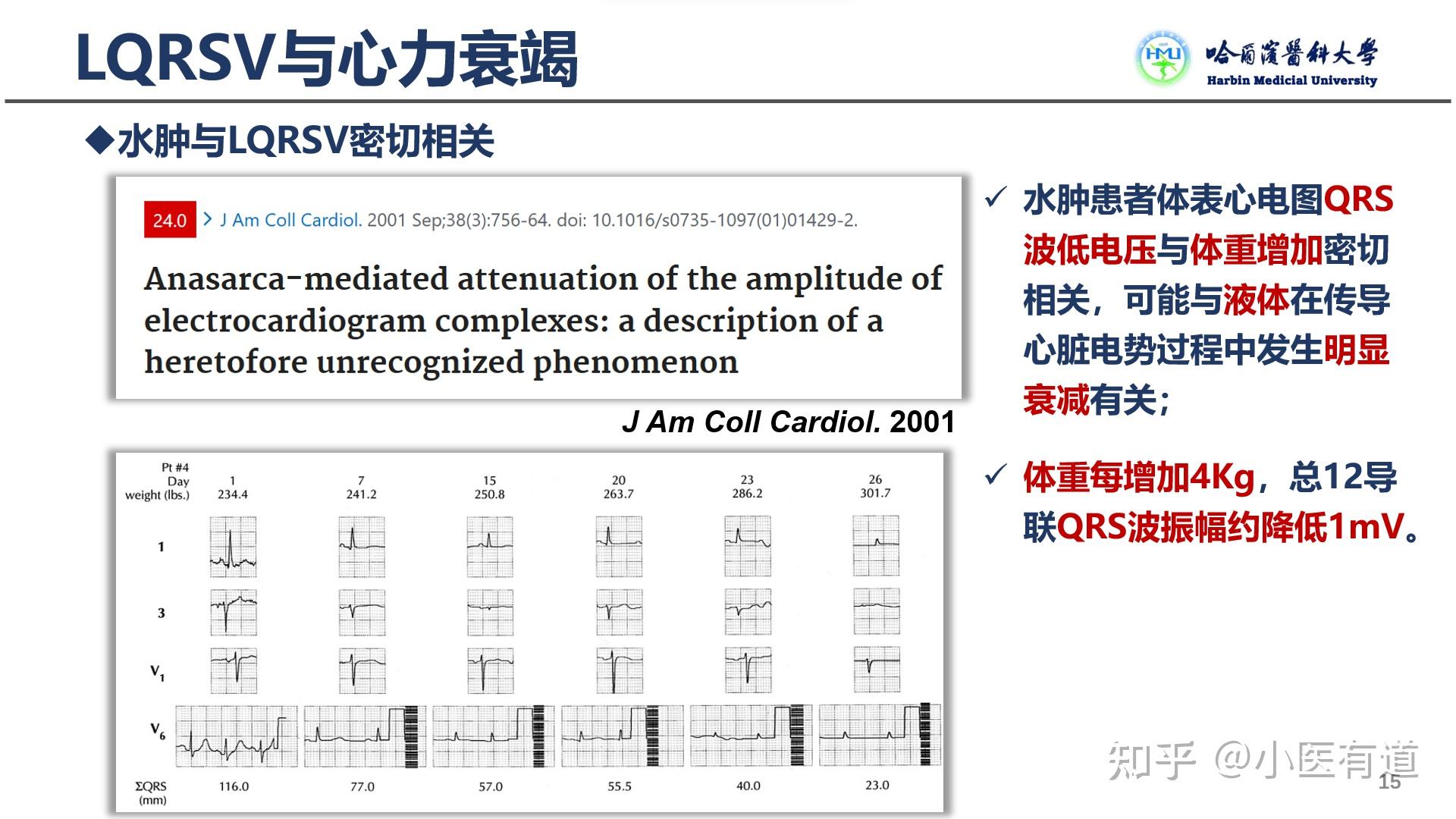 QRS波低电压在心血管疾病中的研究进展 - 知乎