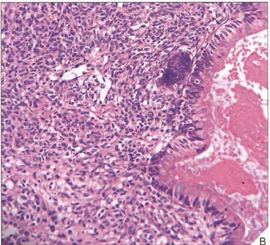 卵巢支持-间质细胞瘤（Sertoli-Leydig Cell Tumors）全面解析 - 知乎