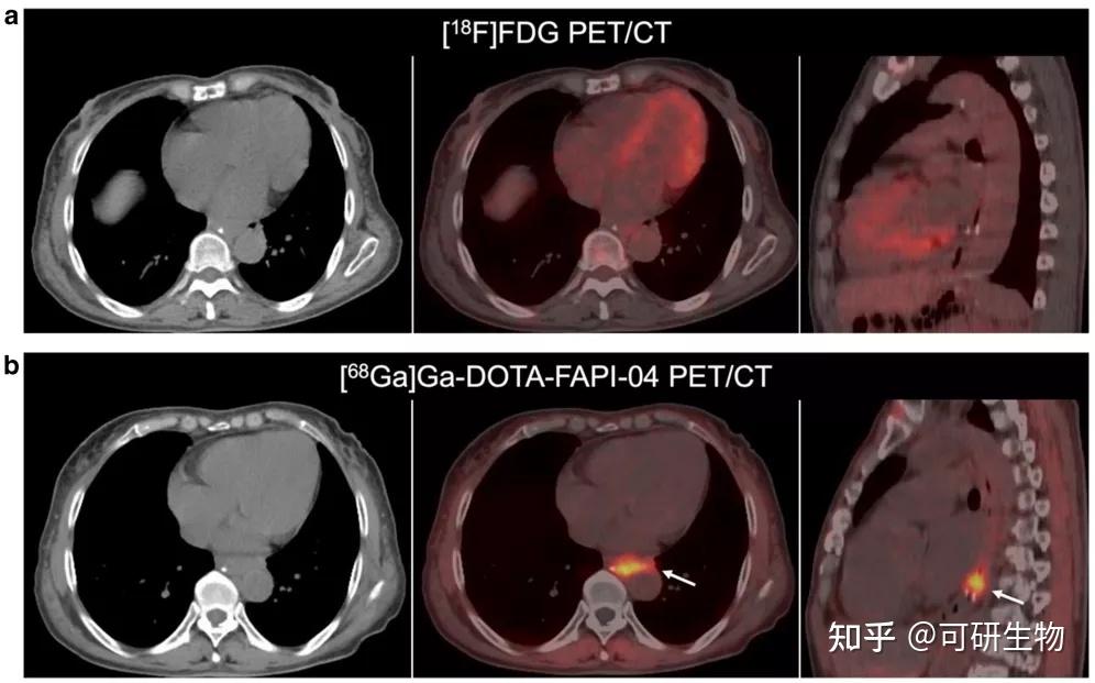 [68Ga]Ga-DOTA-FAPI-04 PET/CT---肿瘤研究新热点！ - 知乎
