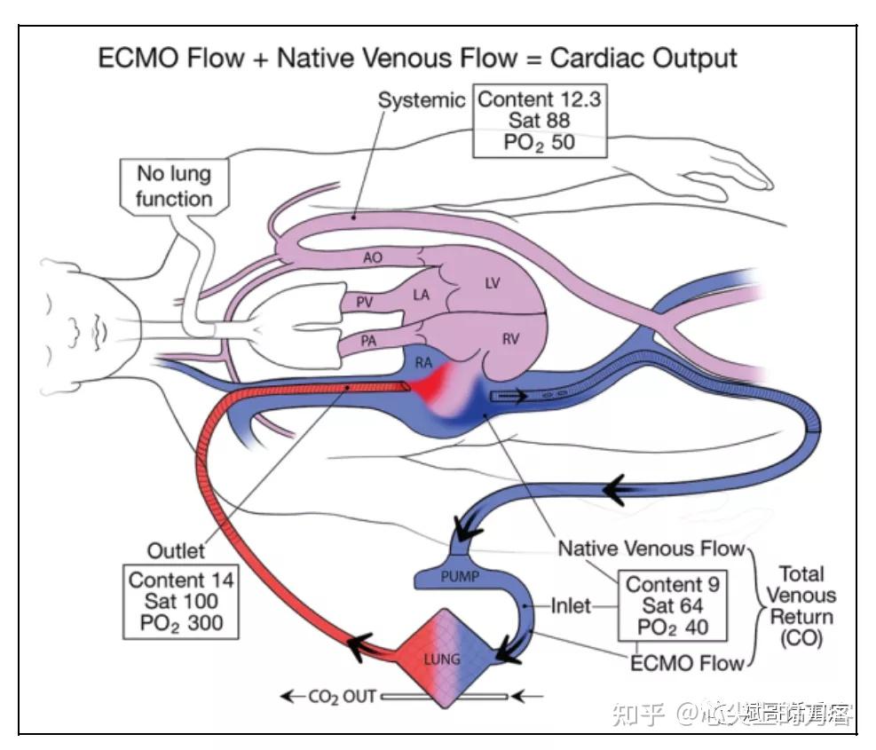 ECMO基础：VV-ECMO期间气体交换的生理学 - 知乎