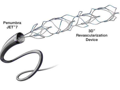 【复星财富】首次覆盖报告 | Penumbra（PEN.US）：神经、外周血栓抽吸龙头 - 知乎