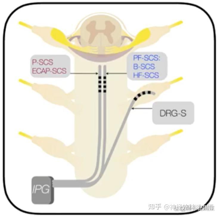 国内脊髓电刺激 (SCS) 神经调控治疗慢性疼痛的发展过程 - 知乎
