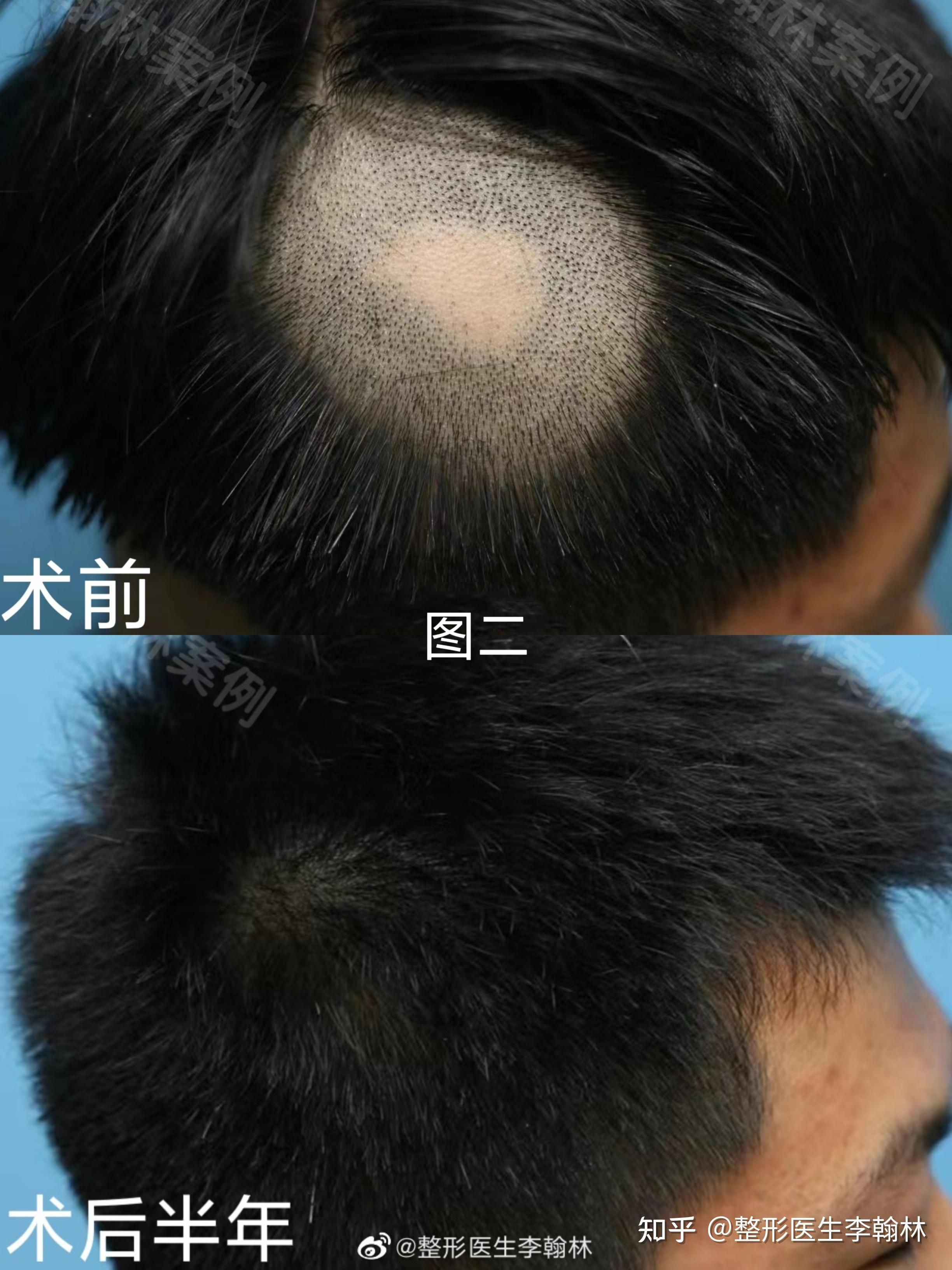 斑秃导致毛囊闭合,还能不能植发? 知乎