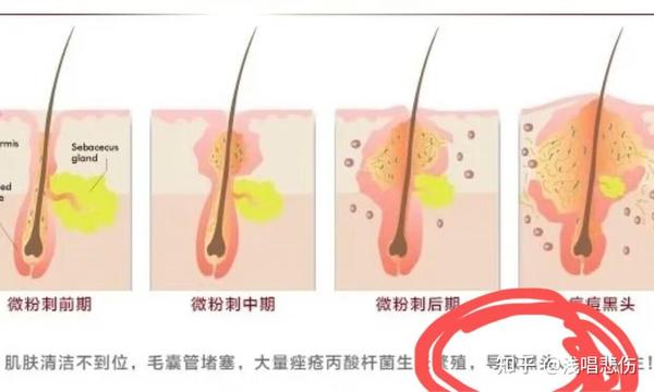 黑头反复长又非常多该怎么办？ 知乎