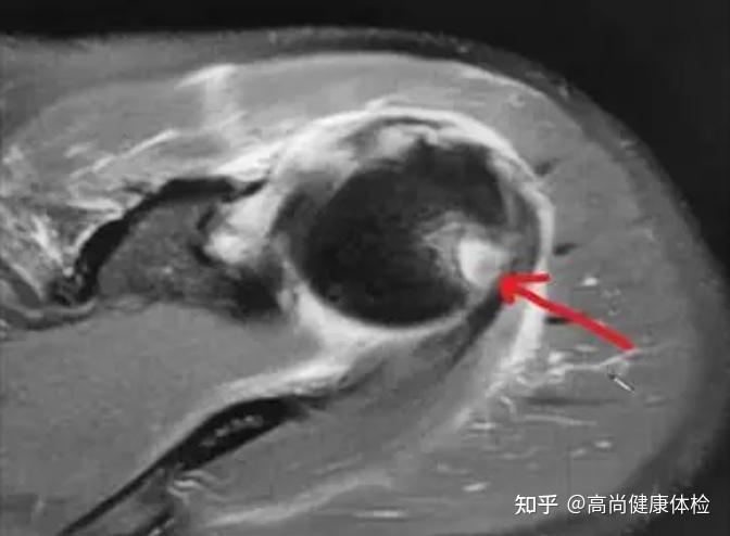 肩关节Hill-Sachs并Bankart损伤 - 知乎