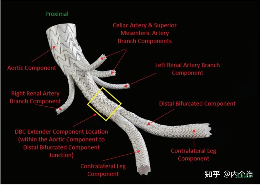 【行业资讯】EXCLUDER胸腹主动脉瘤分支覆膜支架（TAMBE） - 知乎