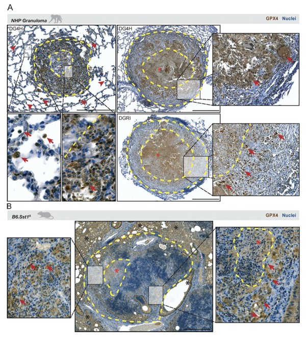 免疫学顶刊JEM丨GPX4-结核病-细胞死亡丨从临床到基础 - 知乎