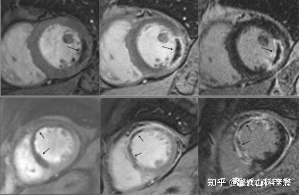 心脏磁共振扫描——EGE - 知乎