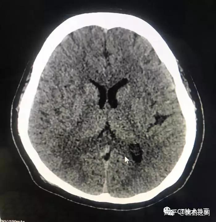 CT窗口技术原理及应用方法 - 知乎