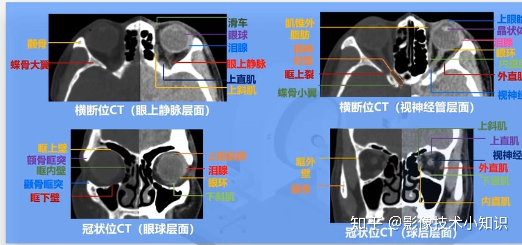 眼的CT解剖 - 知乎