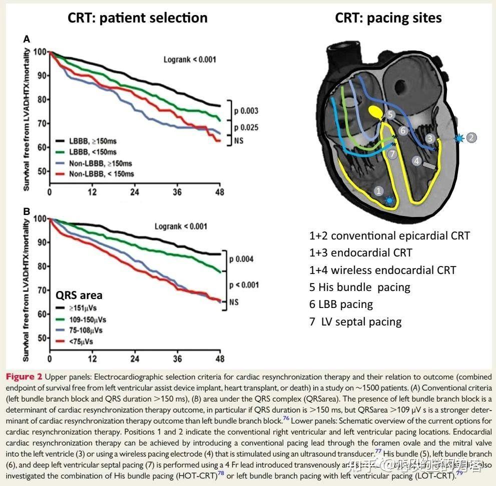 心力衰竭的电学治疗：从病理生理学到治疗 - 知乎