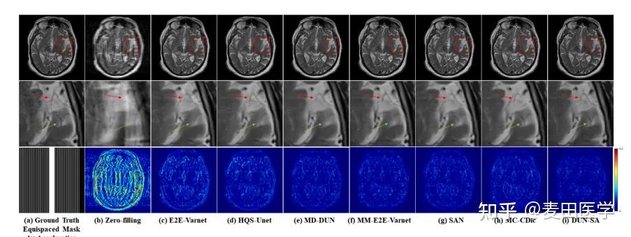 用于多模态MRI重建的深度展开网络与空间对齐|文献速递-生成式模型与transformer在医学影像中的应用 - 知乎