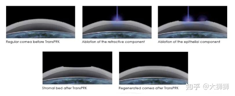 我的近视手术（上篇）为什么我会推荐你首选TPRK，而不是飞秒？ - 知乎