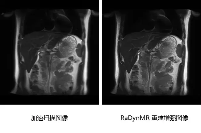 RaDynMR加速腹部肝脏MRI扫描 - 知乎