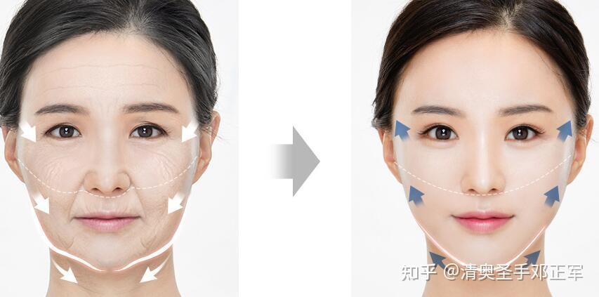 面部拉皮手术能维持多久? 知乎