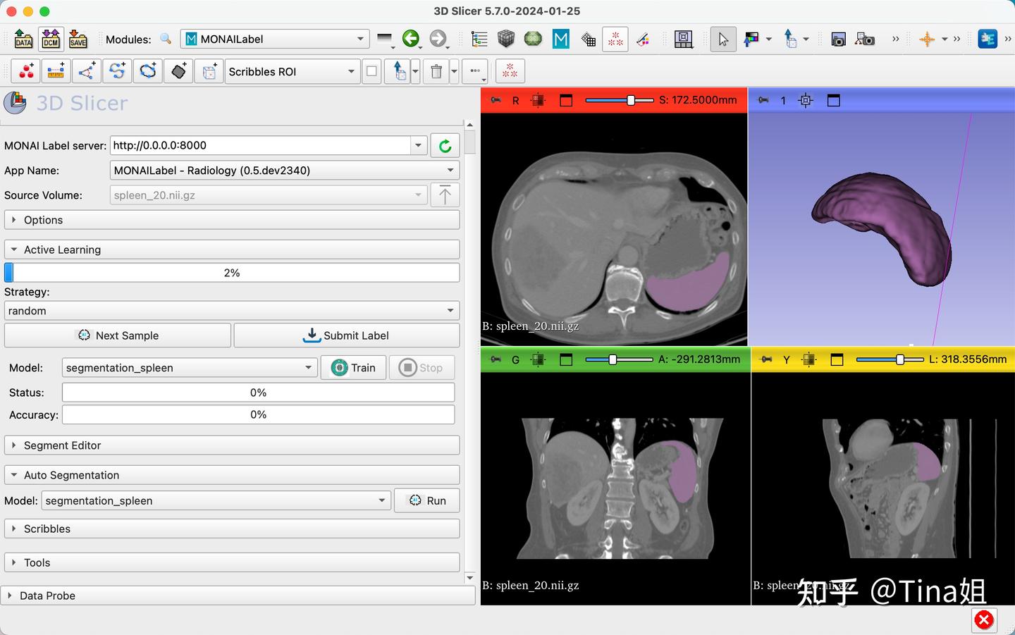 MONAILabel in 3D Slicer 案例1: 在腹部CT中自动分割脾脏 - 知乎