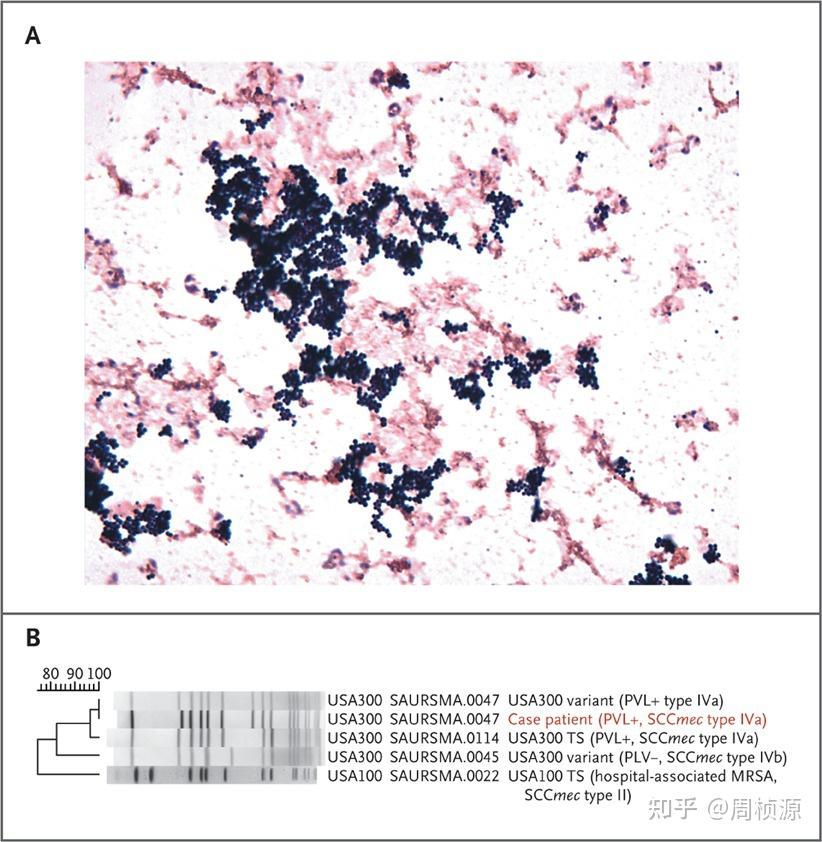 Nejm 2011 Case 2 - 知乎