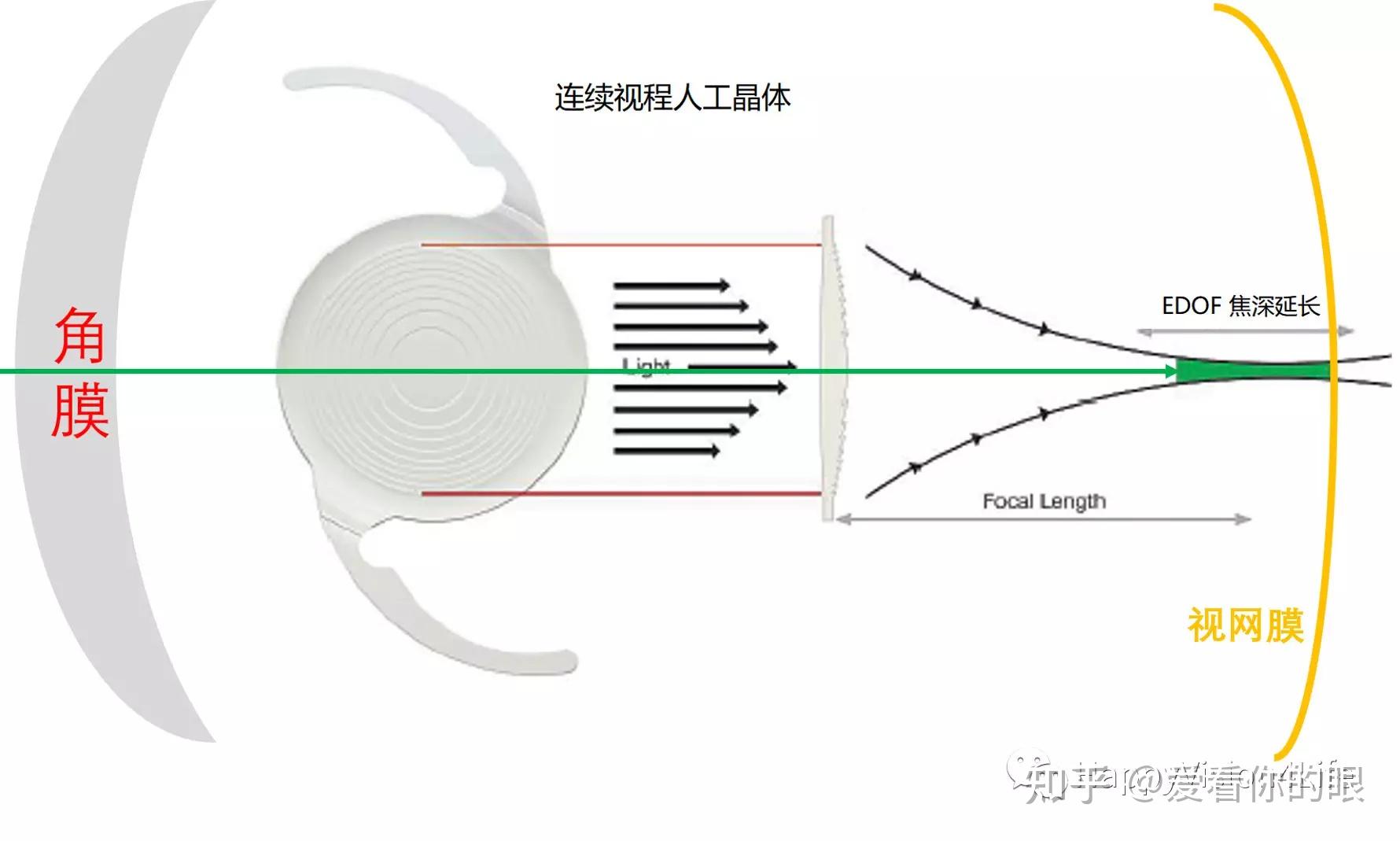 近视防控的新方案:EDOF软镜 - 知乎