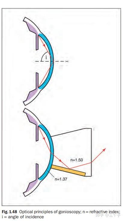 No.25, GONIOSCOPY（1） - 知乎