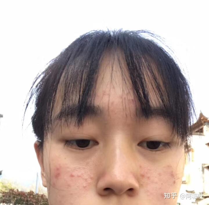 困扰我多年的痘痘终于被我治好 知乎