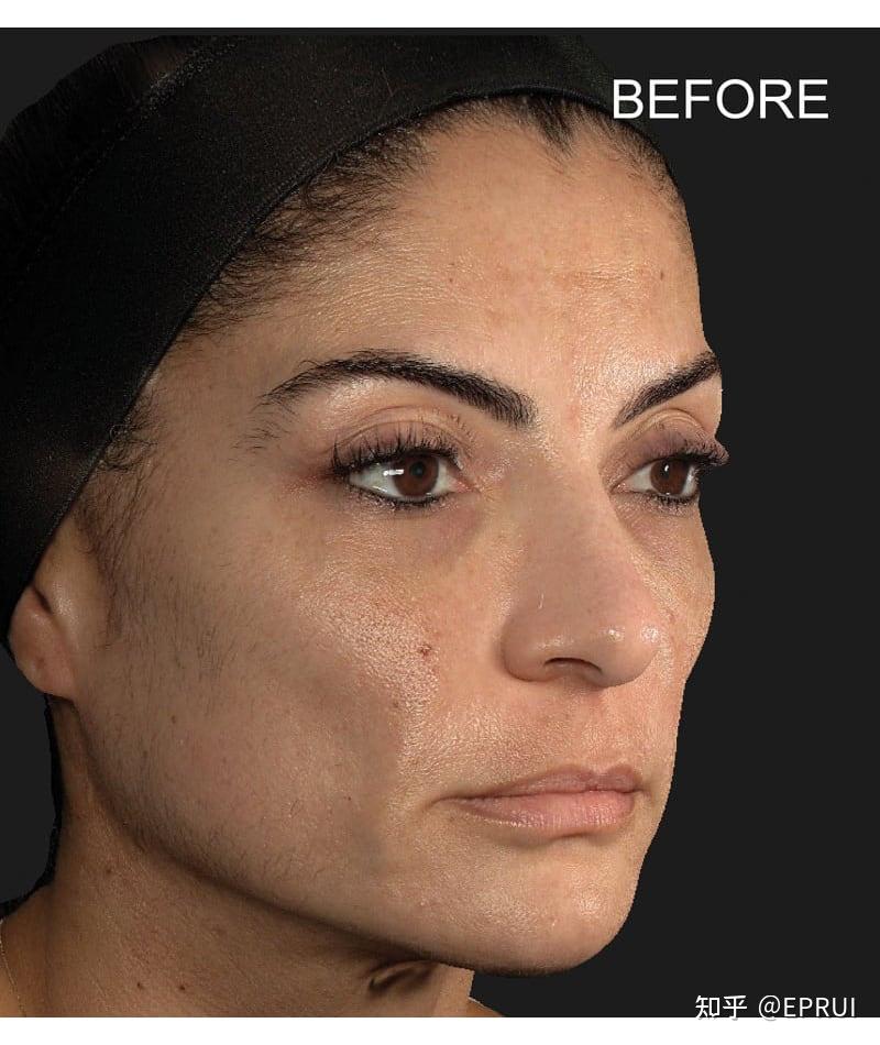 25-45um 医美用CaHA羟基磷灰石微球 - 知乎