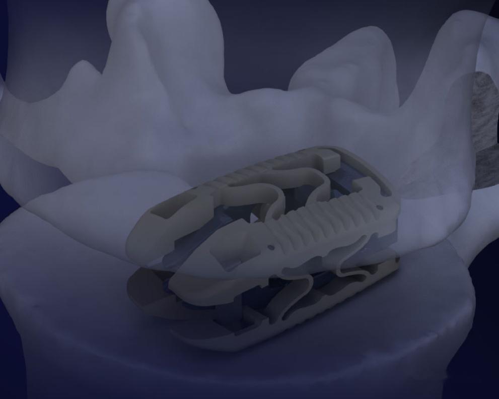 脊柱手术机器人 | Accelus使用Remi导航和LineSider脊柱系统成功进行首次手术 | 临床 - 知乎