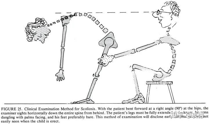 如何判断真假侧弯？ - 知乎