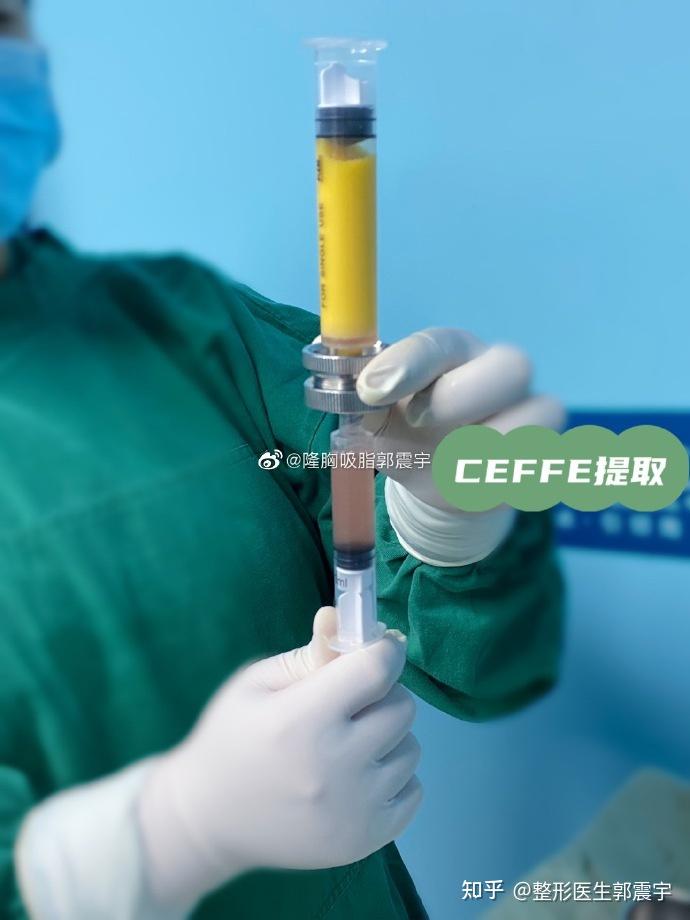 郭震宇CEFFE®自体脂肪隆胸好吗？原理是什么？效果怎么样？ - 知乎