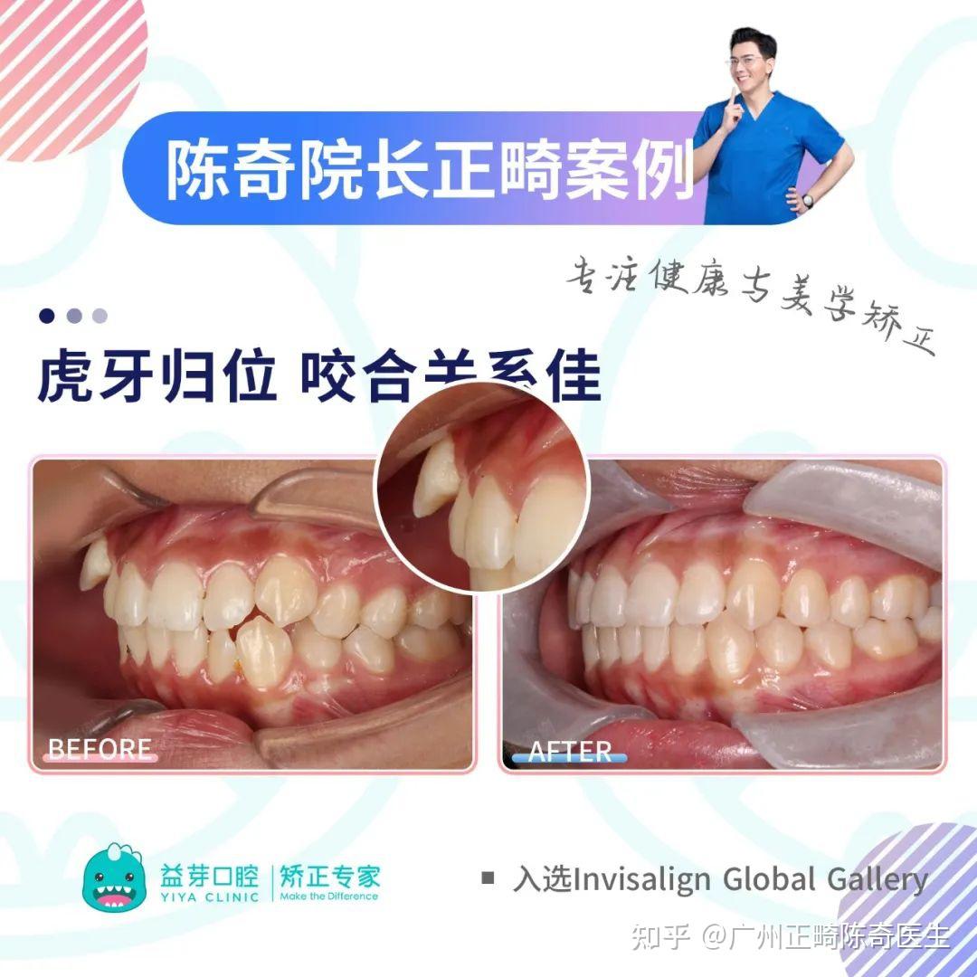 入选Invisalign Global Gallery | 青少年不拔牙矫正，解除牙齿拥挤、改善露龈笑！ - 知乎
