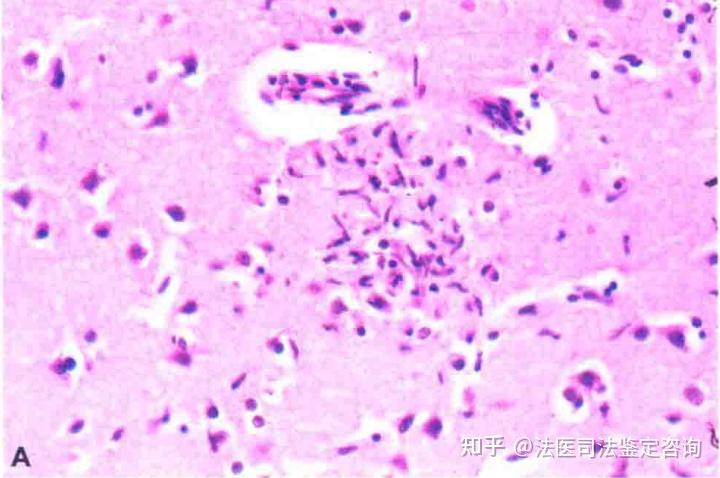 法医病理学——神经系统的细胞及其基本病变 - 知乎