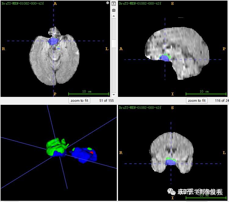 BraTS2023-MEN——BraTS2023颅内脑膜瘤分割挑战赛 - 知乎