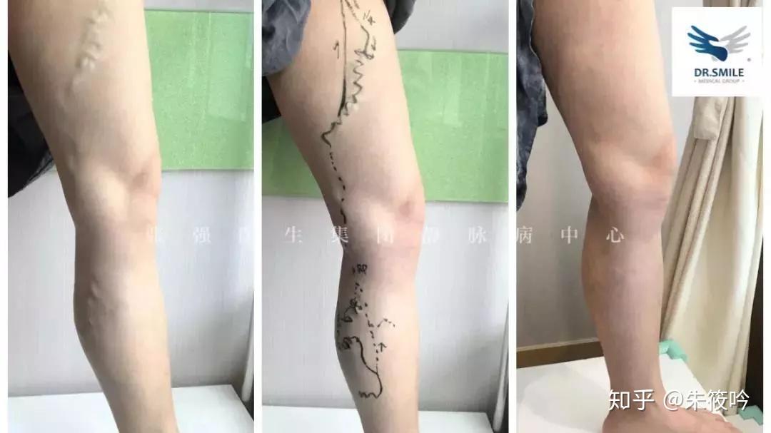 CHIVA治疗下肢静脉曲张：优势与结果 - 知乎