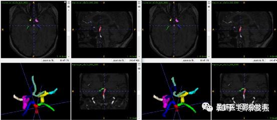 Top_Cow 2023——用于CTA和MRA的Willis环的拓扑解剖结构分割 - 知乎