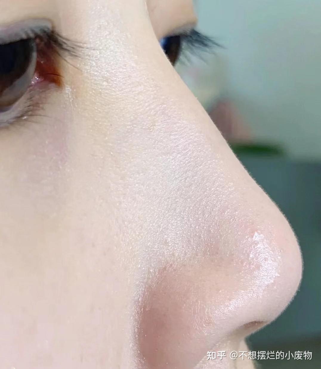 鼻子黑头严重毛孔粗大,李佳琦推荐的果酸真的能去黑头吗?有没有亲自实践过的? 知乎