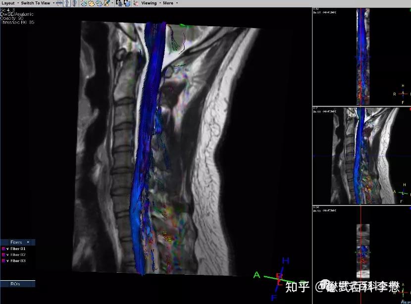 DTI技术原理及临床应用 - 知乎