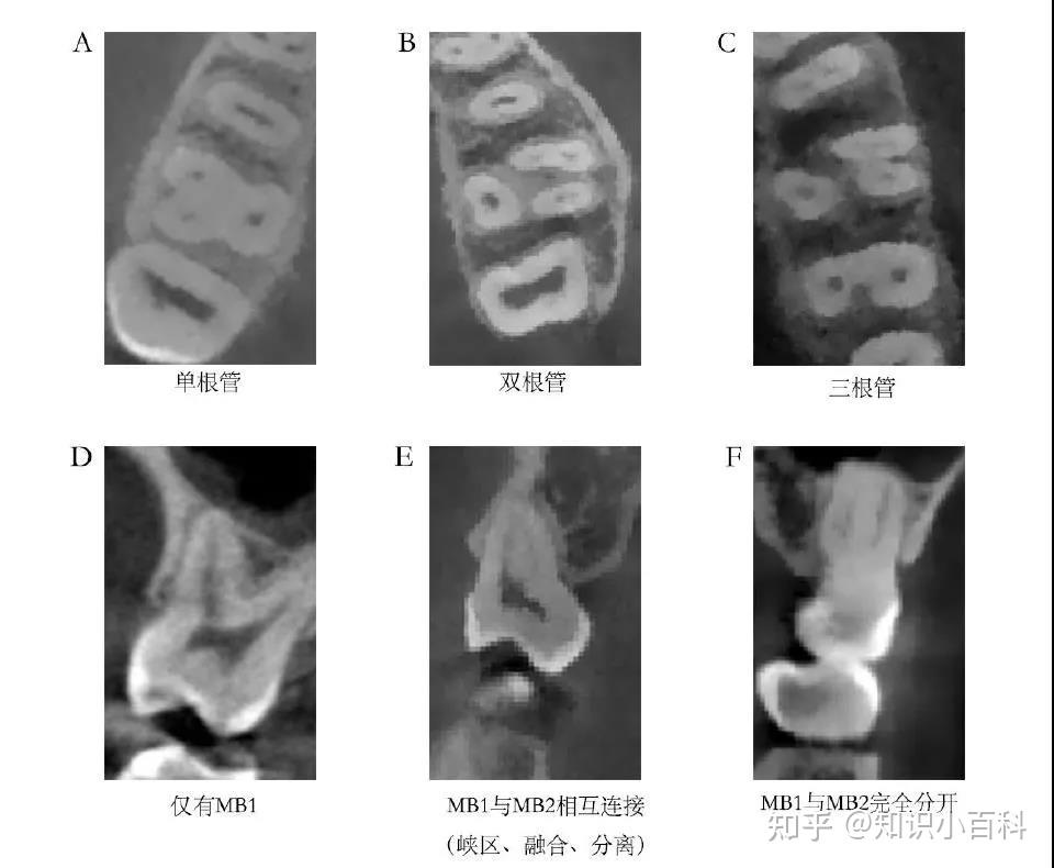 美亚口腔CBCT，让MB2无所遁形！ - 知乎