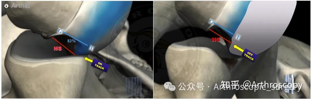 手术理念｜肩关节不稳中“on-track”和“off-track”是什么意思？ - 知乎