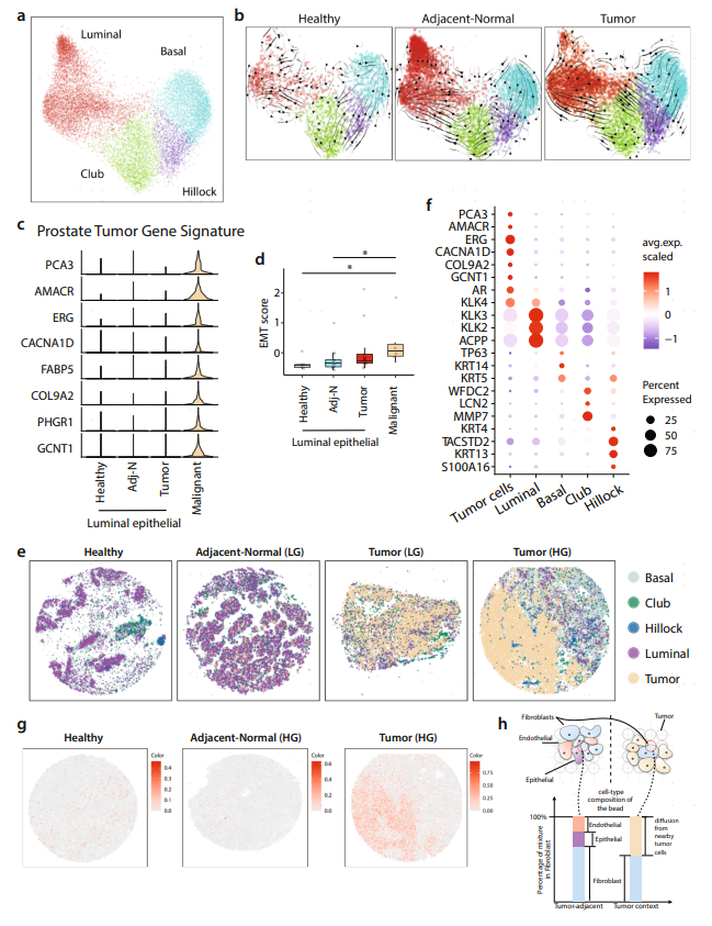 单细胞联合空间转录组剖析人类前列腺免疫抑制肿瘤微环境 - 知乎