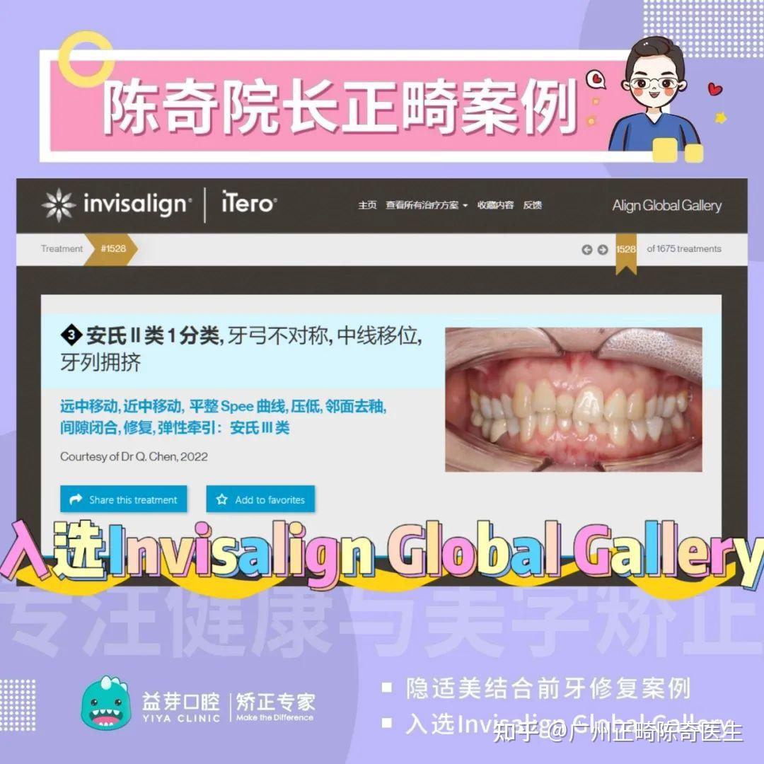 全球优秀案例 | 正畸+美学修复联合治疗，改善笑容质感！ - 知乎