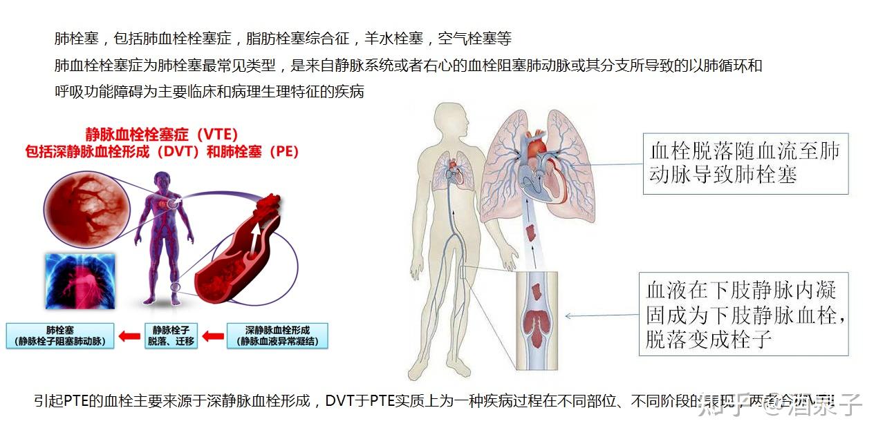 VTE、DVT与PE的关系 - 知乎