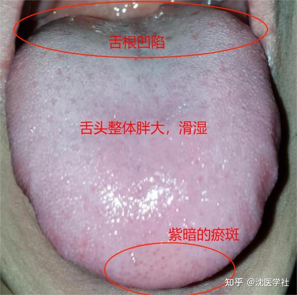 化瘀最好的方法是补阳，先血府逐瘀丸，再桂附地黄丸，瘀血化光光 知乎