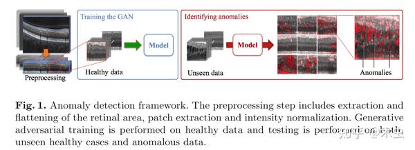 Unsupervised Anomaly Detection With Generative Adversarial Networks To