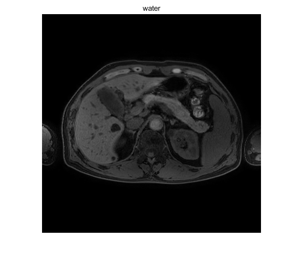 磁共振Dixon技术原理及初代算法解析 - 知乎