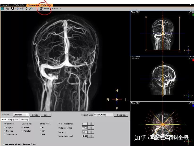 颅脑静脉MRV规范化扫描及临床应用 - 知乎