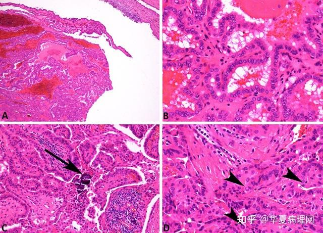分子时代学病理-PTC中的BRAF V600E样非典型 - 知乎