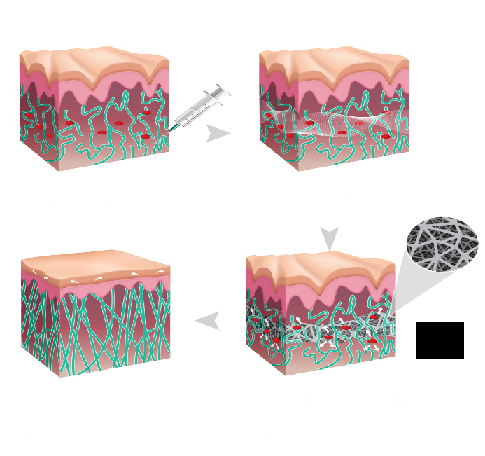 医美新方向，格奥润全液态PCL胶原抗衰，和英伦大提升、首尔大提升有啥区别？ - 知乎