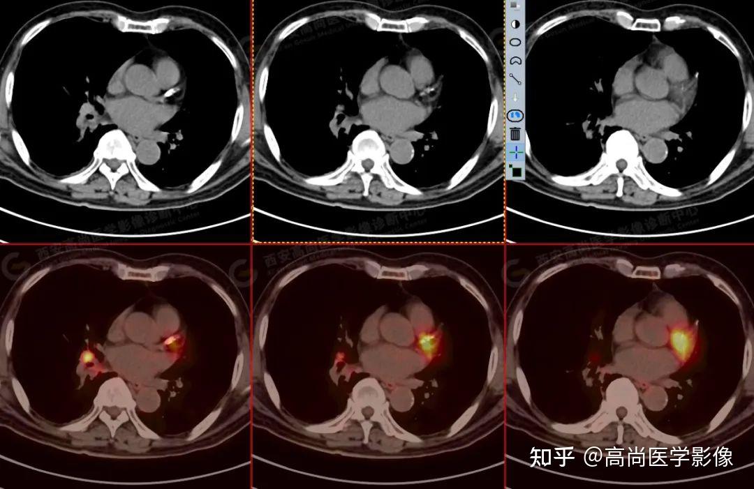 PET/CT病例：肺鳞癌5例【高尚医学影像】 - 知乎