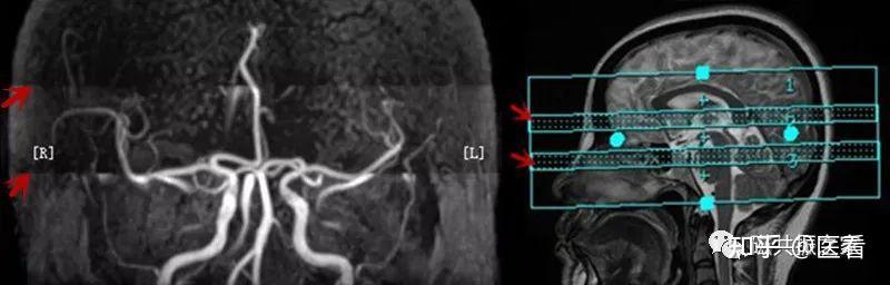 颅内3D TOF-MRA成像中的几个技术要点 - 知乎